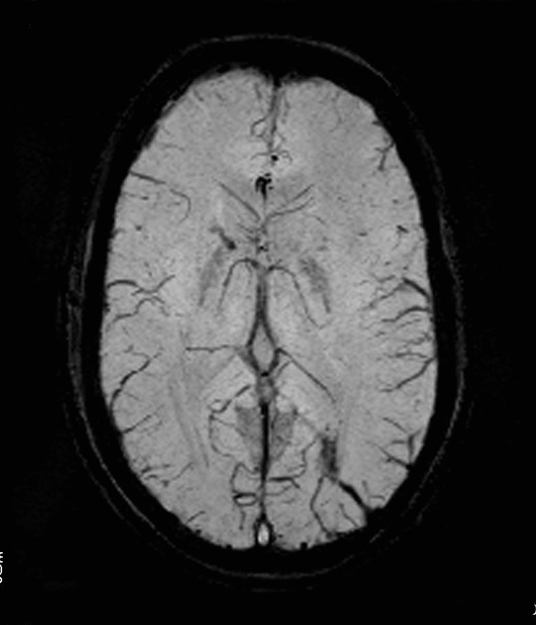 Brain Mri: Routine Brain Mri Protocol Brain Mri: Routine Brain Mri Protocol